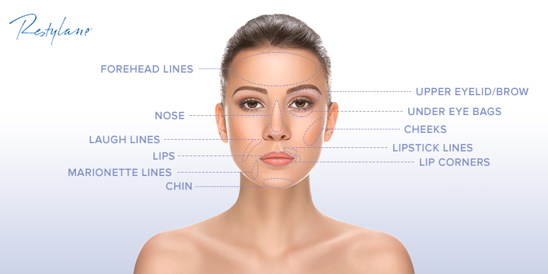 Restylane Filler - Facial Plastic Surgery and Body Contouring San ...